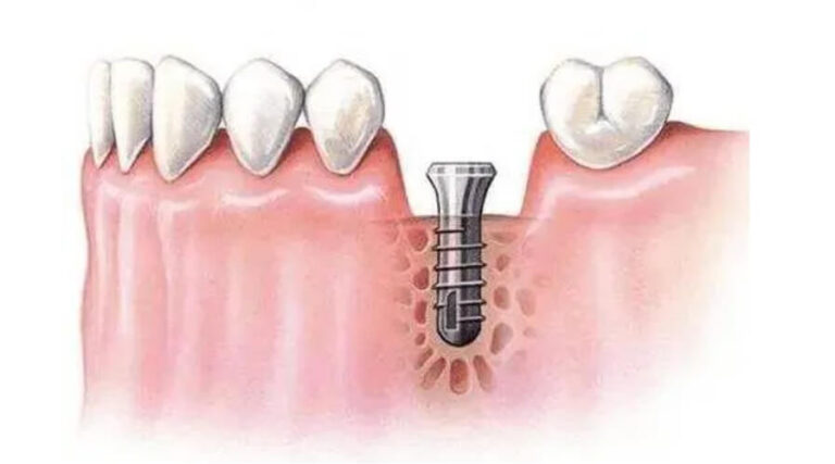 4 Types Of Dental Implants: Types, Material Selection And Processing ...
