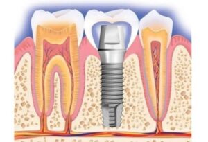 4 Types Of Dental Implants: Types, Material Selection And Processing ...